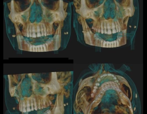 Calcoli salivari: cosa sono e come intervenire. L'esperto risponde ...
